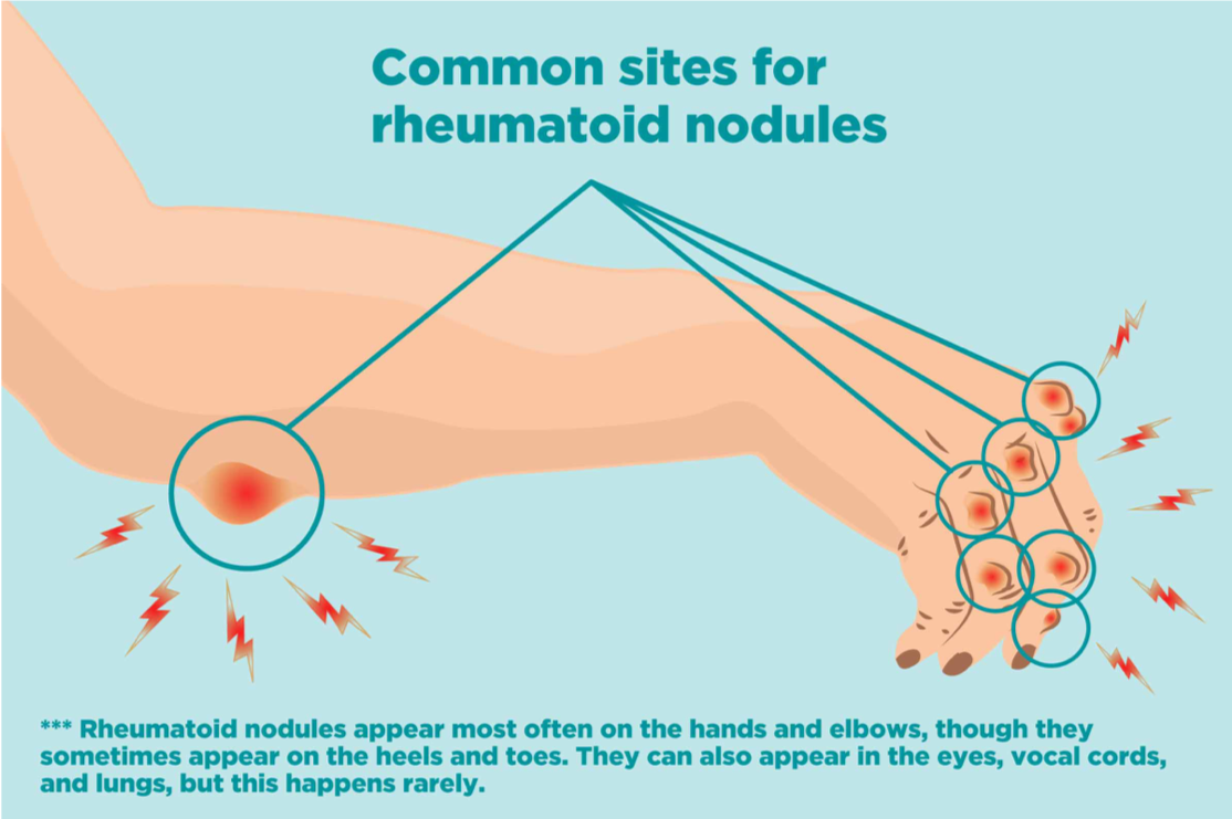 2b. Rheumatoid Arthritis (RA)